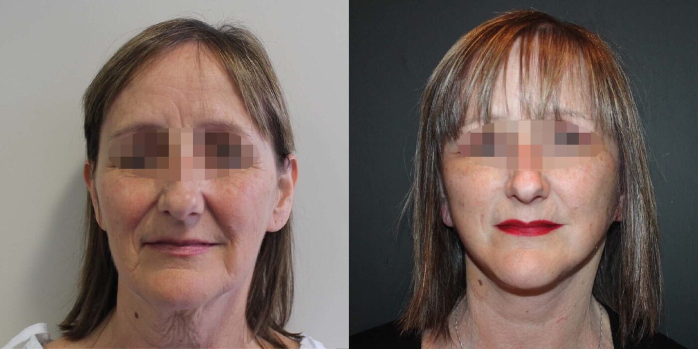 What is the Best Age for a Facelift and Mini Facelift? – Reza Nassab Site
