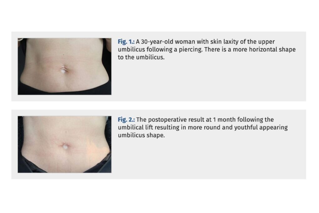 Umbilical Lift Published in PRS Global Open | Reza Nassab